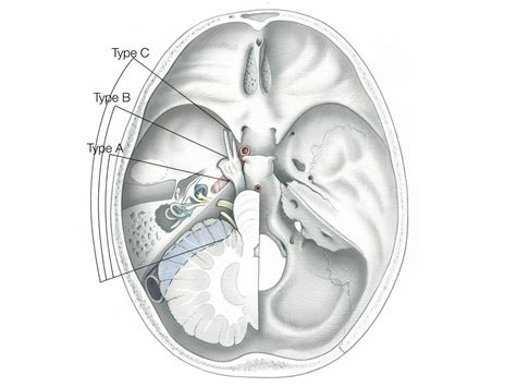 Transcondylar Approach The Neurosurgical Atlas By Aaron Cohen Gadol