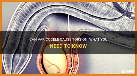 Can Varicocele Cause Torsion What You Need To Know Medshun