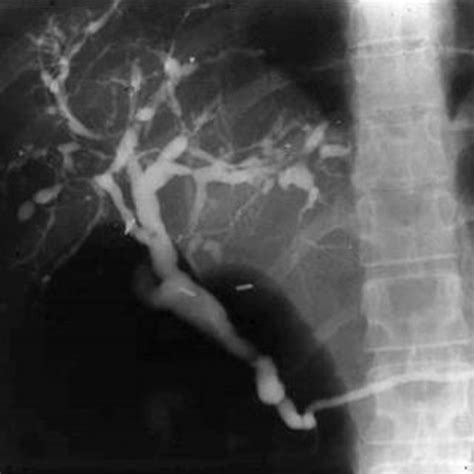primary biliary cirrhosis primary sclerosing cholangitis and other