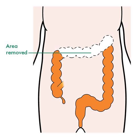 Surgery To Remove Colon Cancer Macmillan Cancer Support