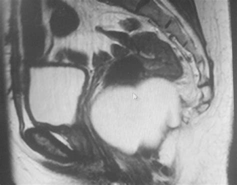 Sagittal T2‑weighted Magnetic Resonance Imaging Showing A Giant Cystic