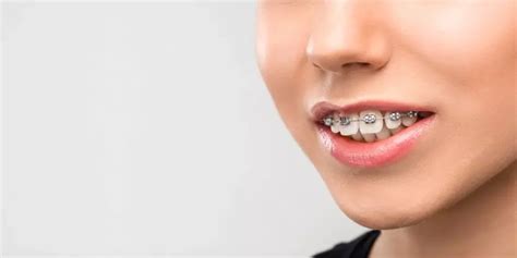 How To Fix An Overbite Causes Types And Correction
