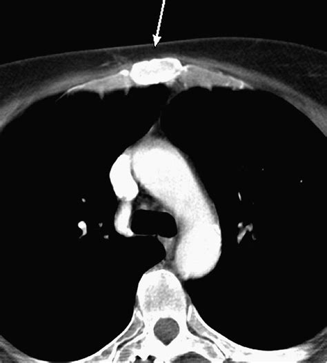 Correlative Anatomy For The Sternum And Ribs Costovertebral Angle