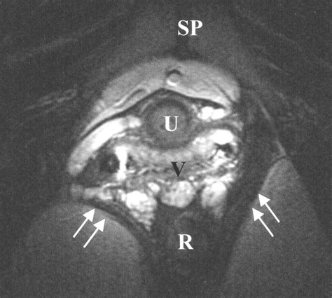 The Urethra And Its Supporting Structures In Women With Stress Urinary