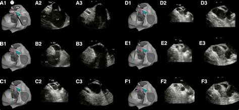 Use Of Intracardiac Echocardiography In Interventional Cardiology