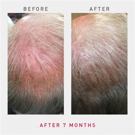 Irestore Laser Hair Growth System Professional Revolt