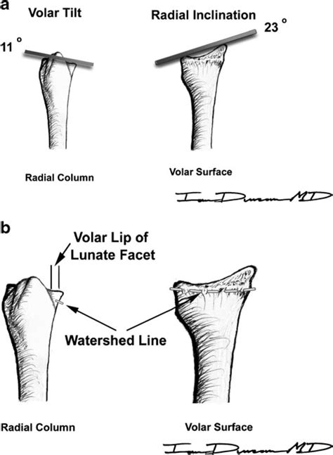 Surgical Approaches To The Distal Radius Asif M Ilyas 2011