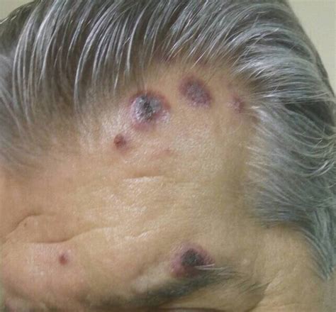 A Case Of Palisaded Neutrophilic Granulomatous Dermatitis With