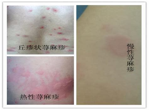 蕁麻疹瘙癢難耐、夜不能寐？教你4個方法快速止癢 每日頭條