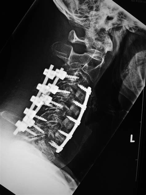 Cervical Spine Fusion Hardware