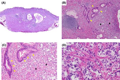 Histological Findings Of The Resected Sample By Endoscopic Submucosal