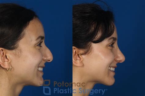 Bump Reduction In Rhinoplasty Potomac Plastic Surgery