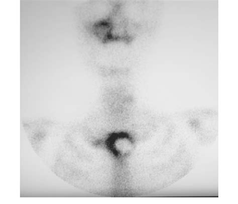 Bone Scintigraphy With Tc99 M Mdp Showing Increased Uptake Indicative