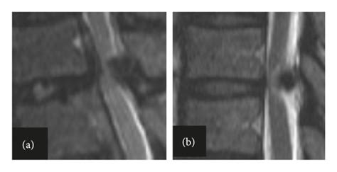 The Shape On The Sagittal Mri Of Tolf Sagittal T2 Weighted Mr Images