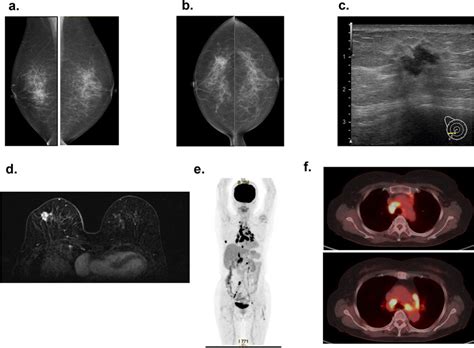 Preoperative Imaging Findings A Mediolateral Oblique View Mammogram B