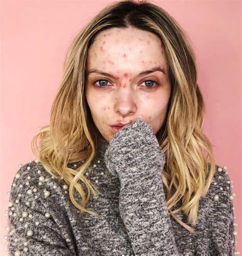 10 Inspiring Images That Prove Acne Is Not Ugly Artofit