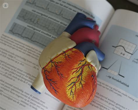atrial flutter your comprehensive guide top doctors