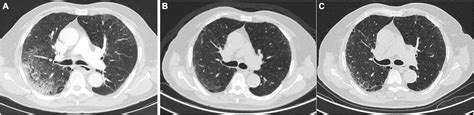 Frontiers Risk Factors For Persistent Tomographic Abnormalities At 6