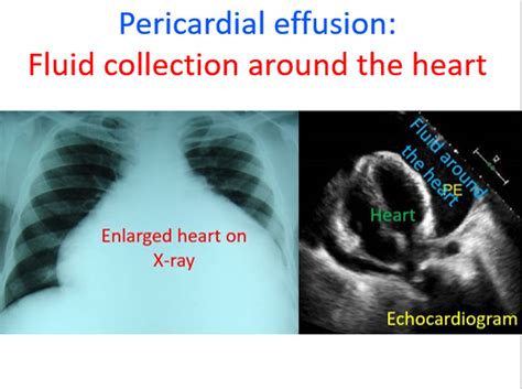 Pericardial Effusion Fluid Collection Around The Heart All About