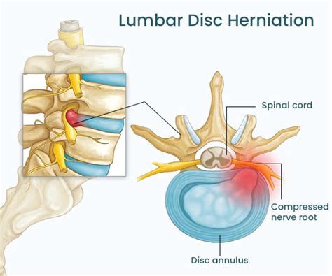 Disc Herniations Bulges Mandurah Chiropractor And Massage Flex Health