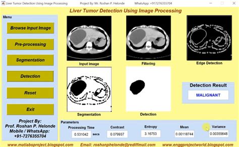 Breast Cancer Detection In Mammograms Using Neural Network Matlab