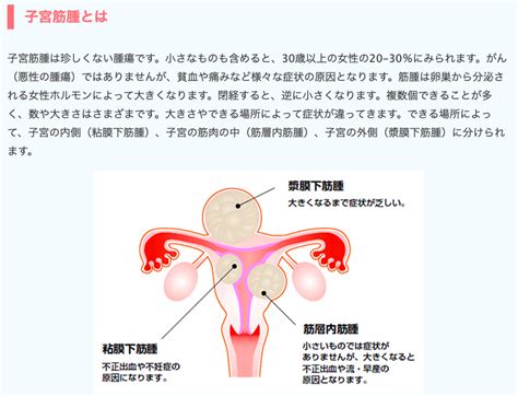 子宮筋腫について知る Soluna