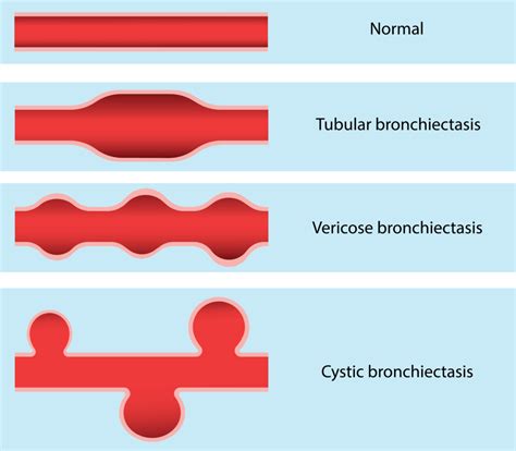 Causes Symptoms Diagnosis And Treatment Of Bronchiectasis Holistic