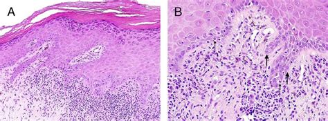 Hypertrophic Lp At Labium Majus A Marked Hyperkeratosis And