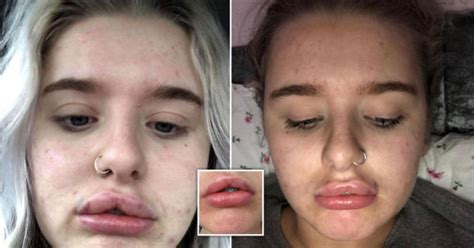 Womans Confidence Shattered After Lip Fillers Spread Across Her Face