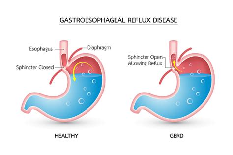 Gastroesophageal Reflux Disease Stock Illustration Download Image Now