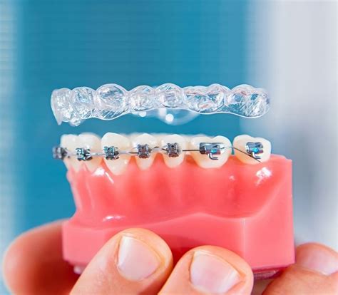 Invisalign® Vs Braces Which Is Best For You Dr Alex