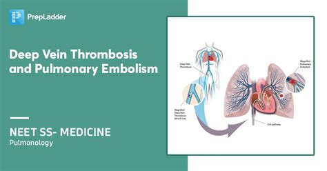 Deep Vein Thrombosis And Pulmonary Embolism