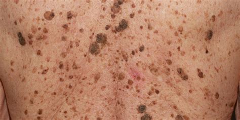Seborrheic Keratosis Back