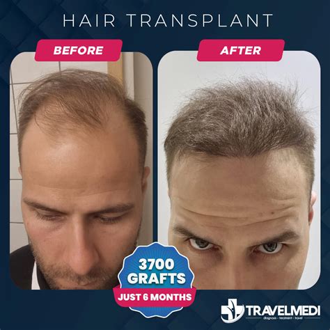 Fue Hair Transplant Prices Before After 2024