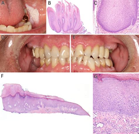 Characterization Of Initial Early Histologic Features Of Proliferative
