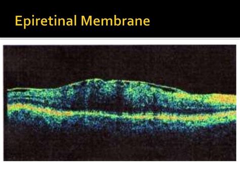 Oct Introduction And Macular Disorders