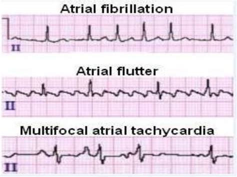 Afib Atrial Flutter