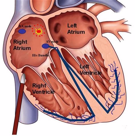 atrial fibrillation catheter ablation