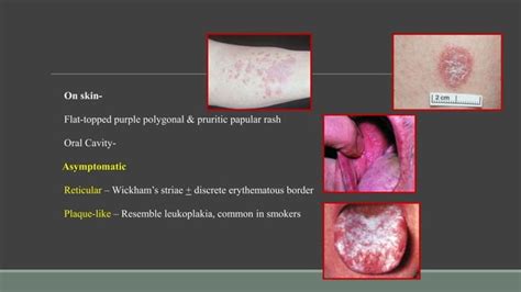 Precancerous Lesions Of Oral Cavity