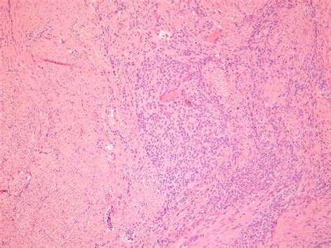Uterine Tumors Resembling Ovarian Sex Cord Tumors Identified At