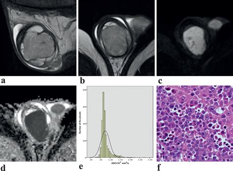 Characterization Of Testicular Germ Cell Tumors Whole Lesion Histogram