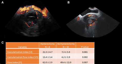 Prospective First Trimester Transvaginal 3 Dimensional Power Doppler