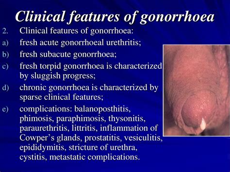 Gonorrhoea Nongonorrhoeal Urethritis Online Presentation