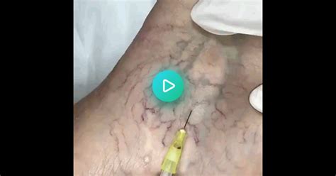 An Interesting Look At A Varicose Vein Treatment Called Sclerotherapy