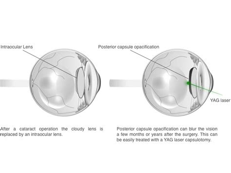 Yag Laser Treatment In London Post Cataract Care Clinica London