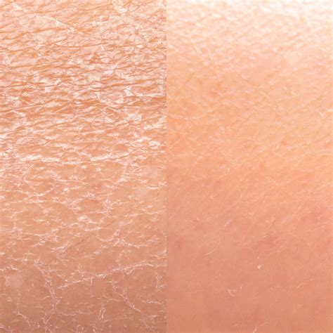Prendre Soin Dune Peau Sèche Eau Thermale Avène