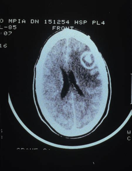 Toxoplasma Gondii Images Hiv