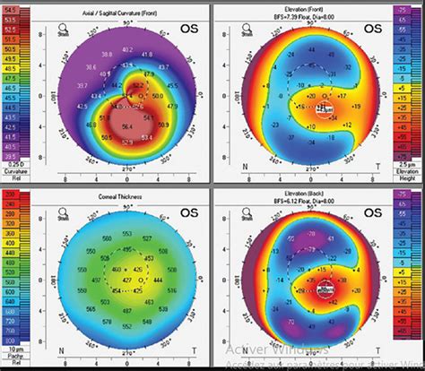 Deep Learning Models Based On Cnn Architecture For Early Keratoconus