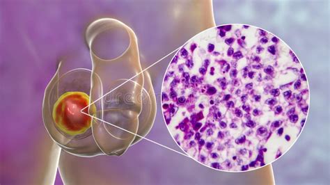 Testicular Seminoma Germ Cell Tumor Of The Testis Stock Illustration