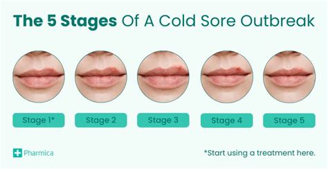 Cold Sores Hsv 1 Stages Treatments And Prevention